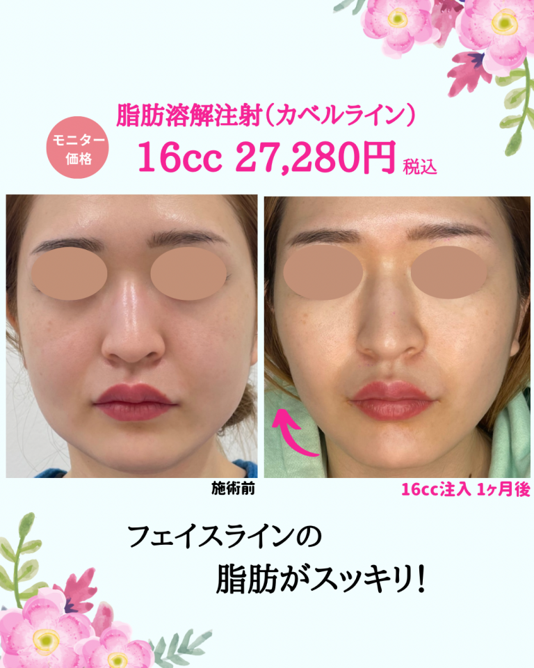 脂肪溶解注射16ccの効果 20歳女性（カベルライン）那覇の美容皮膚科 | クララビューティクリニック那覇院